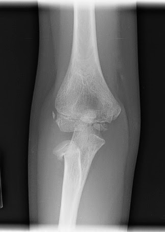 Shoulder and Elbow Surgery: Pediatric radial neck fractures