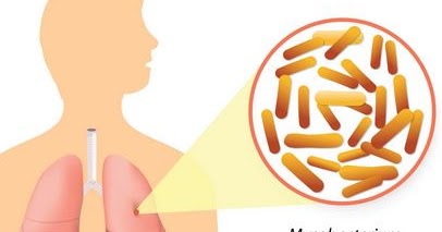 Laboratorium Analis Kesehatan: Definisi, Gejala, Pencegahan, Penularan ...