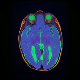 Nevit's blog: Color MRI of the BRAIN