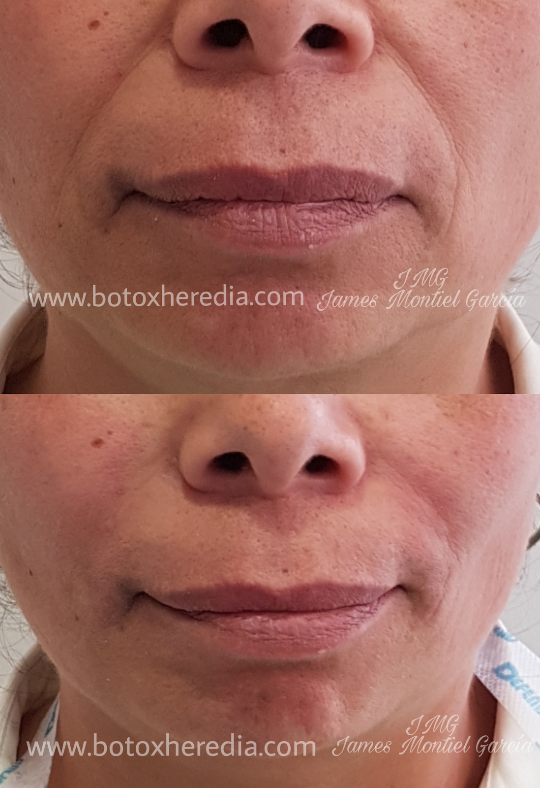 Botox, Acido Hialurónico, Bichectomia, Invisible Touch Hilos Pdo