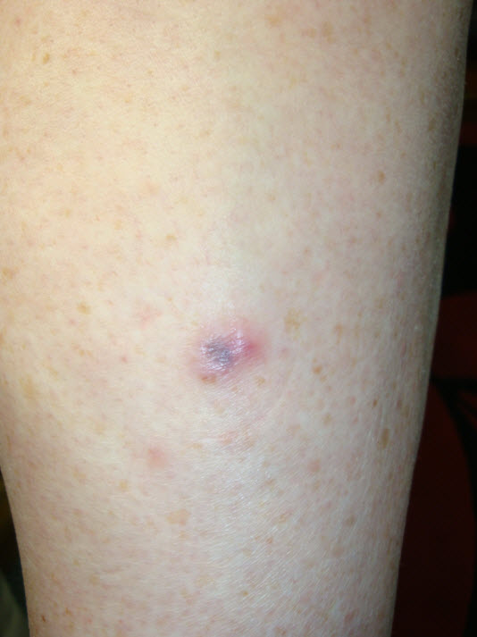 Dermpath Made Simple - Neoplastic: Dermatofibroma