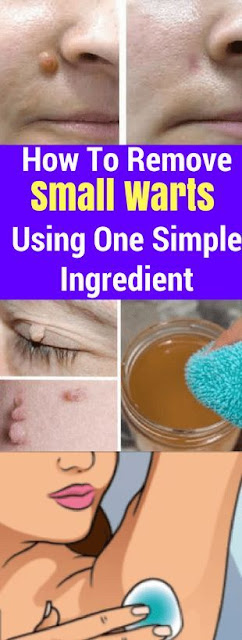 How To Remove Small Warts Using One Simple Ingredient - HEALTH ROOTS