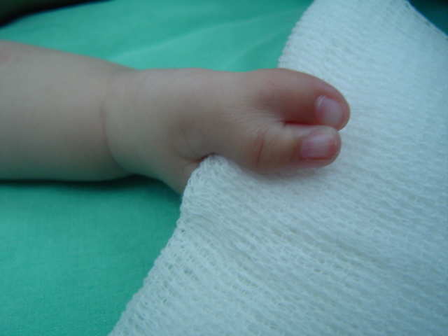 Sobre técnicas de imágenes médicas (Blog STIM): Polidactilia