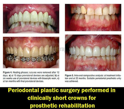 PDF: Periodontal Plastic Surgery performed in clinically short crowns ...