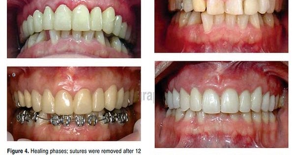PDF: Periodontal Plastic Surgery performed in clinically short crowns ...