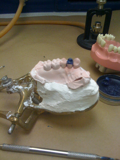 Wax up kits | Student Doctor Network Forums