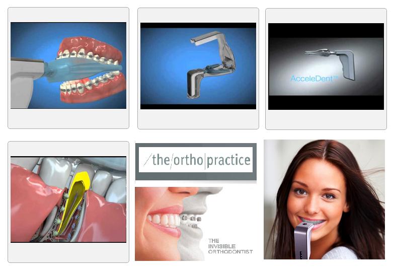 AcceleDent Device – What is AcceleDent | The Orthodontics Practice