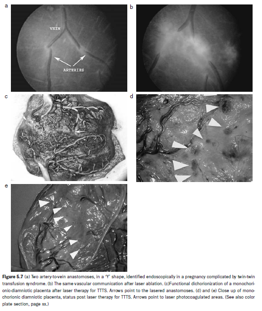 Vascular Communications | Twin-Twin Transfusion Syndrome (TTTS)