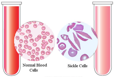 Biology Behind: Sickle Cell Disease - Science in the City