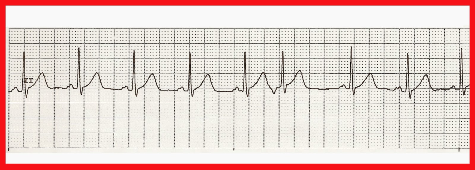 Practice Rhythm Strips 242