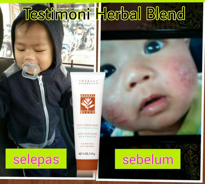 Krim berkesan dan cepat hilangkan ruam susu pada bayi - Cantik Sihat Corner