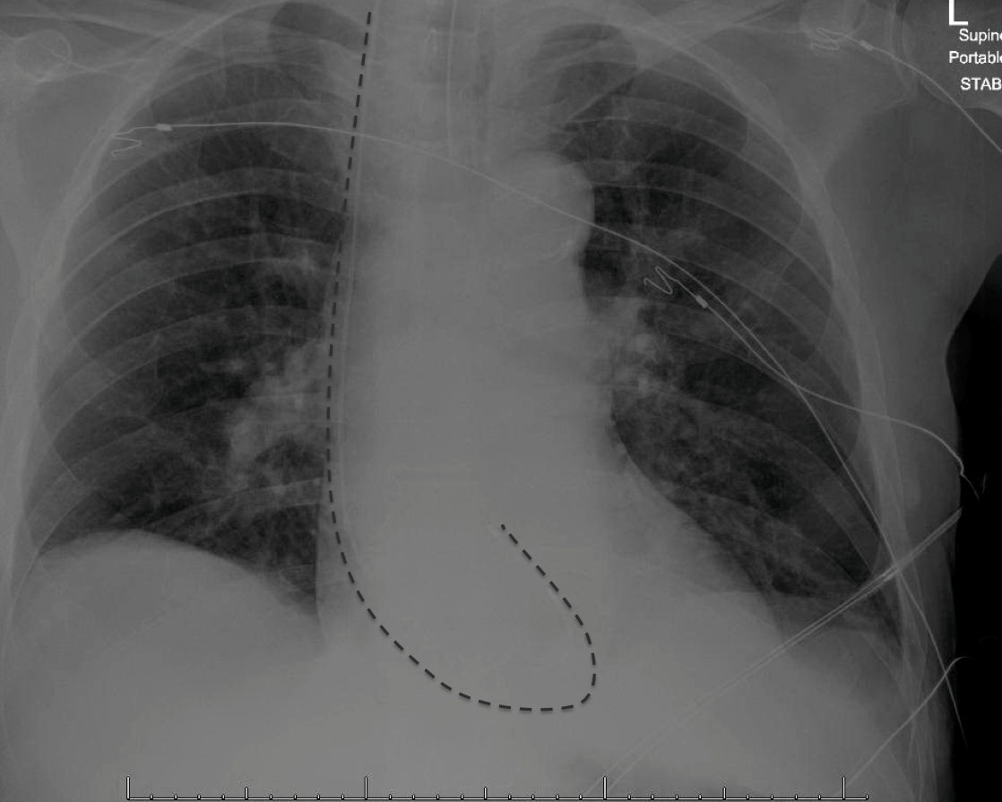 Dr. Smith's ECG Blog: Emergency Transvenous Cardiac Pacing