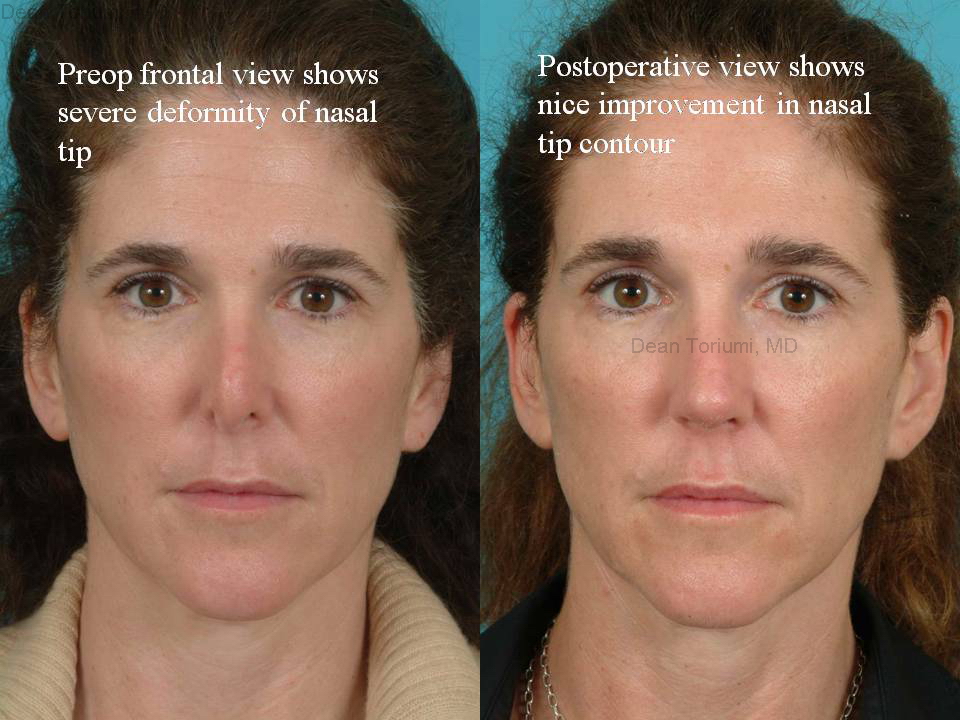 Dr. Dean Toriumi Reviews: Dean Toriumi Reviews: Severe nasal tip ...