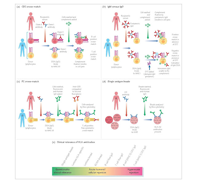 Detecting HLA Antibodies - pediagenosis
