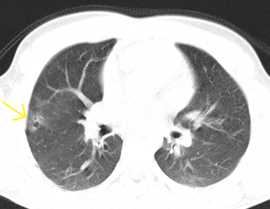 Traumatic Lung Cyst-CT - Sumer's Radiology Blog