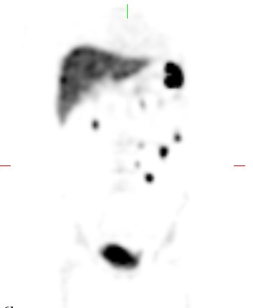 NuCleaR MuNkeE: Liver Spleen Scan Using Denatured Red Blood Cells