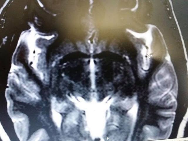 Amyotrophic lateral sclerosis: MRI - Sumer's Radiology Blog