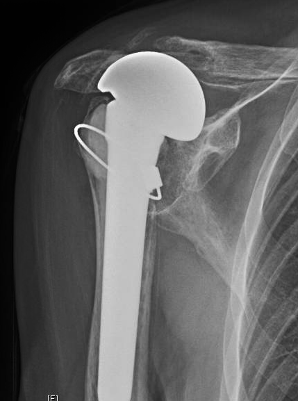 UW Shoulder and Elbow Academy: Mechanical failure of reverse shoulder ...