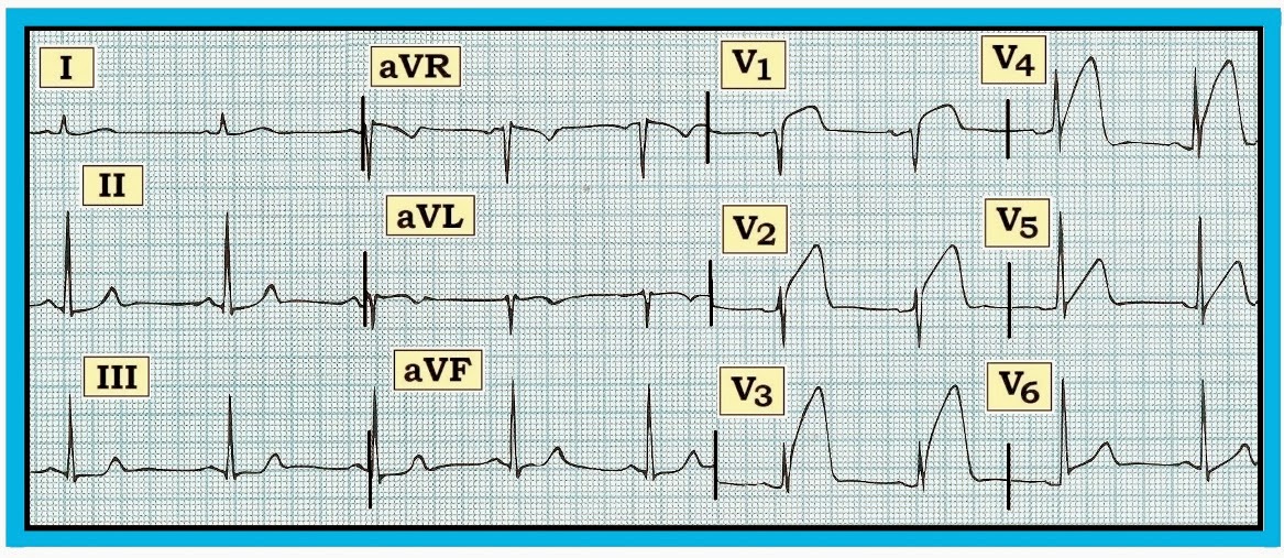 ECG Interpretation: ECG Interpretation Review #82 (Acute STEMI – RCA ...