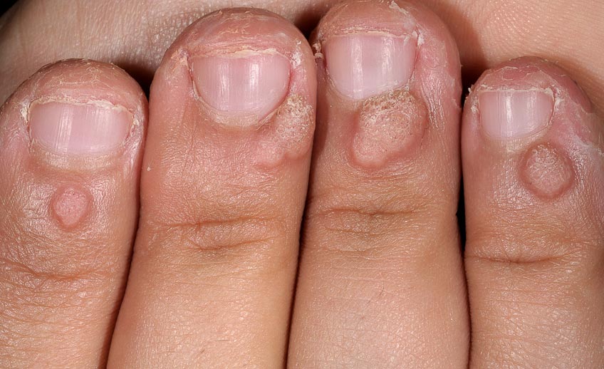 Acrocordones vs. Verrugas: 6 datos para diferenciarlos - ¿Y cómo vas de ...