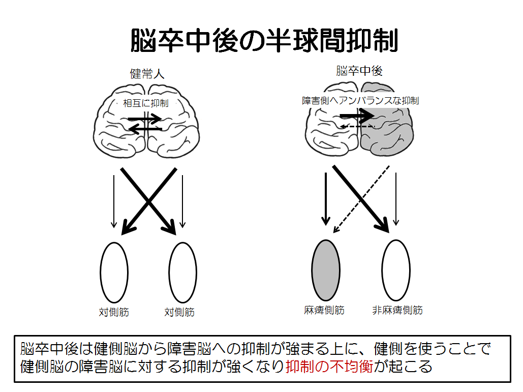 脳卒中リハビリの必要知識 ~半球間抑制~ 改善式リハビリ・脳梗塞リハビリステーション名古屋