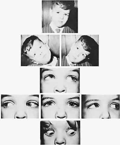 Eye 2 Eye Optometrists: Bielschowsky's head tilt (3 step) test