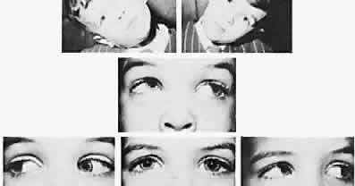 Eye 2 Eye Optometrists: Bielschowsky's head tilt (3 step) test