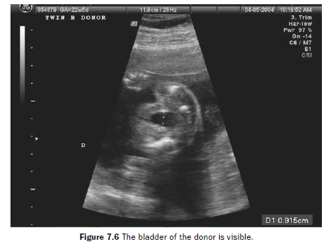 Twin-Twin Transfusion Syndrome (TTTS): 2017