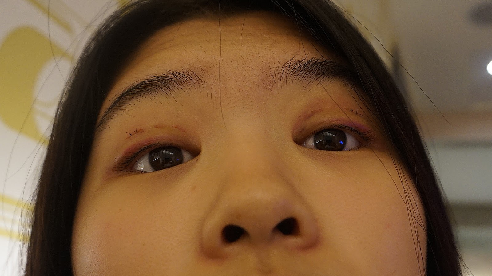 My double eyelid stitching - osmyuki