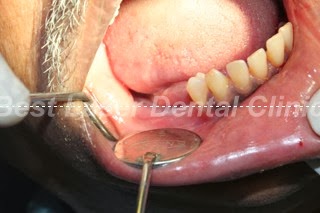 » Failed RCT crown removed and replaced with dental implant supported ...