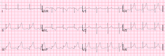 Dr. Smith's ECG Blog: Inferolateral STEMI: is there right ventricular ...