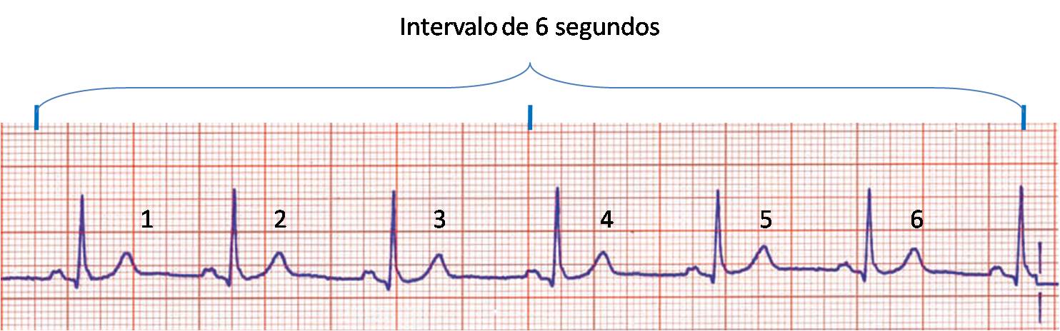 telemedicina EKG: frecuencia cuando el ritmo es irregular