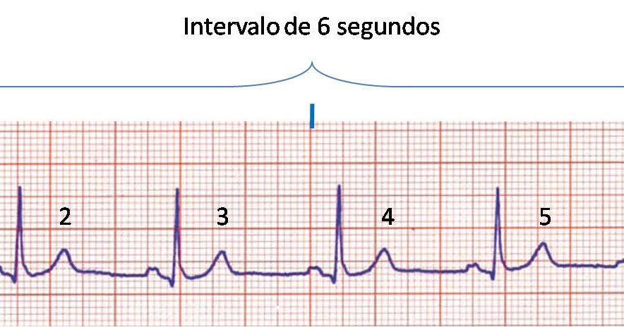 telemedicina EKG: frecuencia cuando el ritmo es irregular