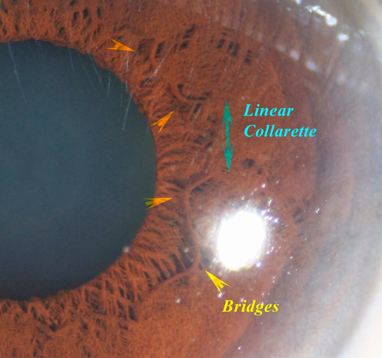 Modern & Multidimensional Iridology: Collarette Structure in Modern ...