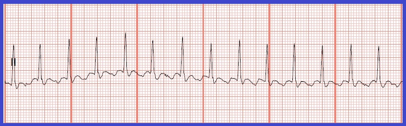 Practice EKG Rhythm Strips 208