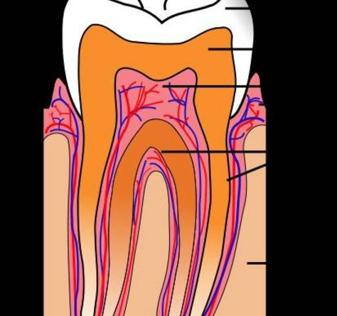 Steppler Dental: How Does a Cavity Form Under a Crown?