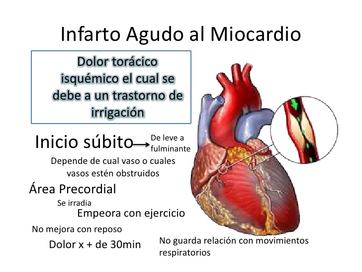 Que es infarto al Miocardio ? ~ Fisioterapia
