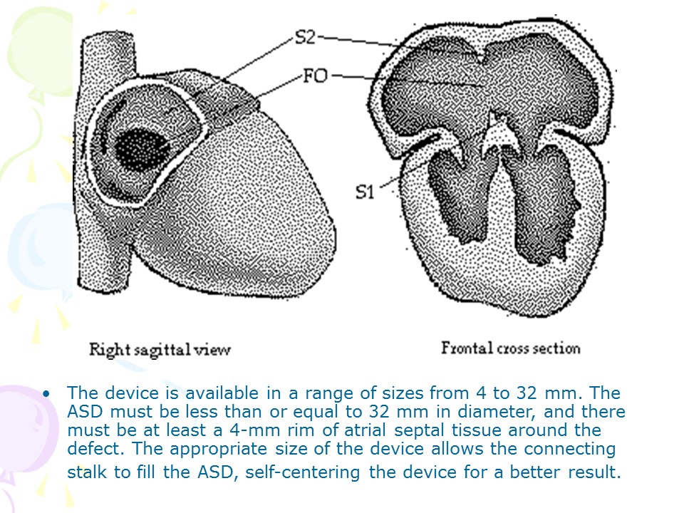 CVT Mohd Farid: ASD Closure For Cardiovascular Technologist