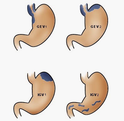 My Gastro Room: Gastric Fundal Varices