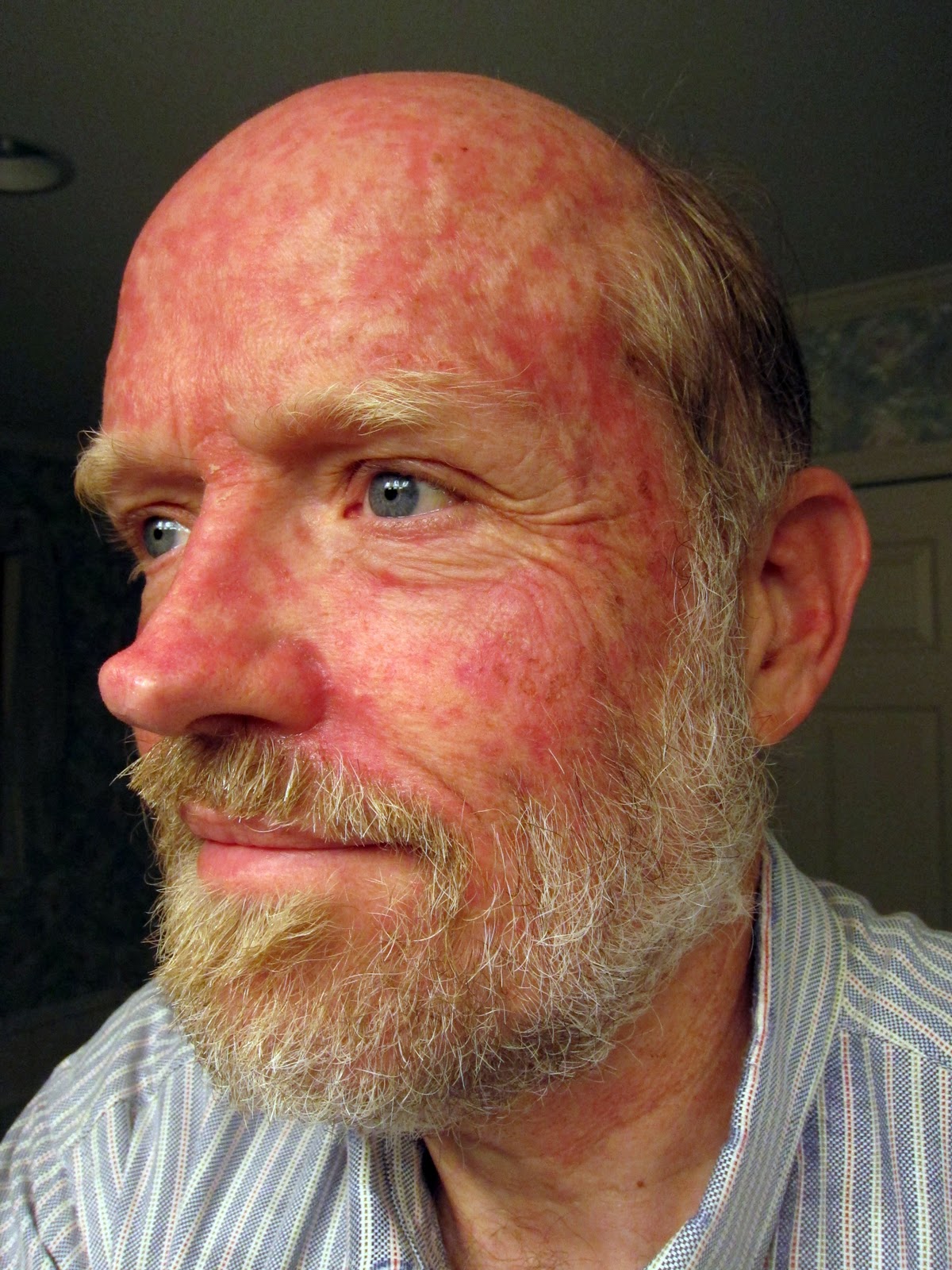 Efudex - Round Two: Day 20 (Recovery Day 6)