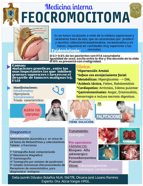 DIVULGACIÓN CIENTÍFICA UG: Feocromocitoma