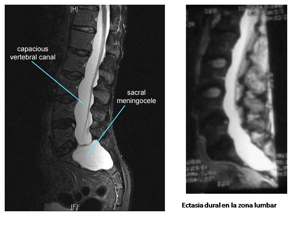 Ectasia dural en la zona lumbar