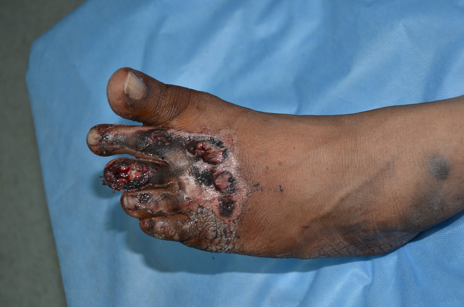 Skin Friction Injury