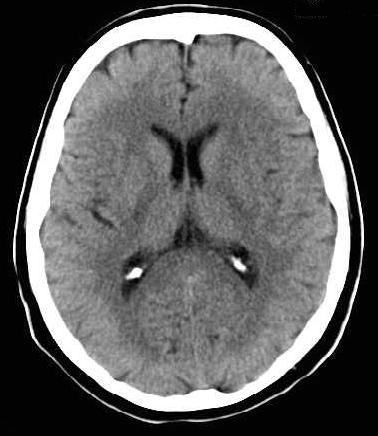 ABC Radiology Blog: The Disappearing Basal Ganglia Sign