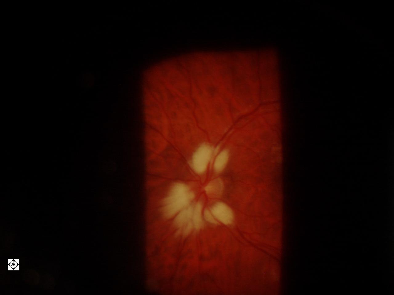 Sonoran Desert Eye Center: MYELINATED NERVE FIBERS