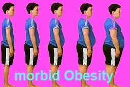 Definitions of morbid Obesity