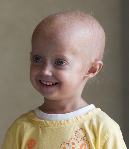 East Coast Cosmetic Surgery: A Link Between Normal Aging and Progeria