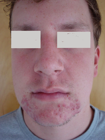 VIRTUAL GRAND ROUNDS IN DERMATOLOGY 2.0: Atypical Acneiforn Eruption