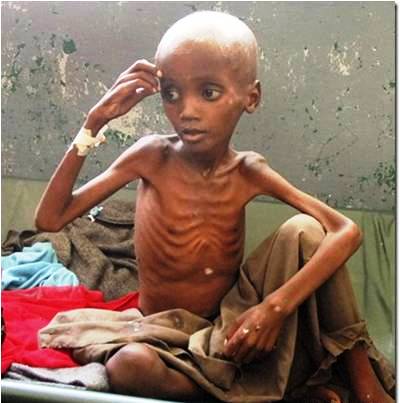 desnutrición infantil