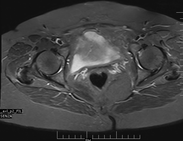 Gluteus Medius-The Neglected One-MRI - Sumer's Radiology Blog